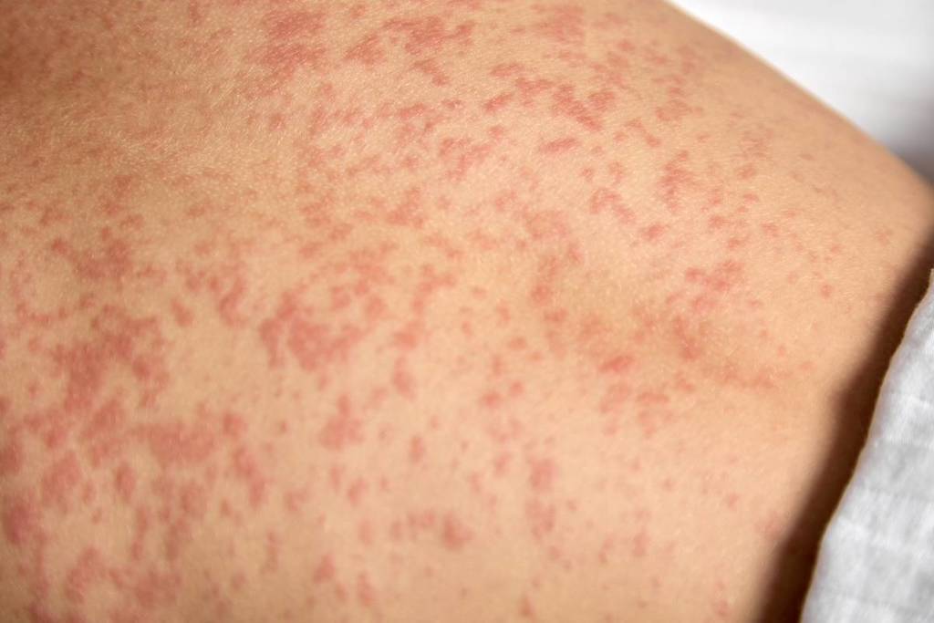 2 Measles Cases Confirmed in Chicago—Here's What to Know