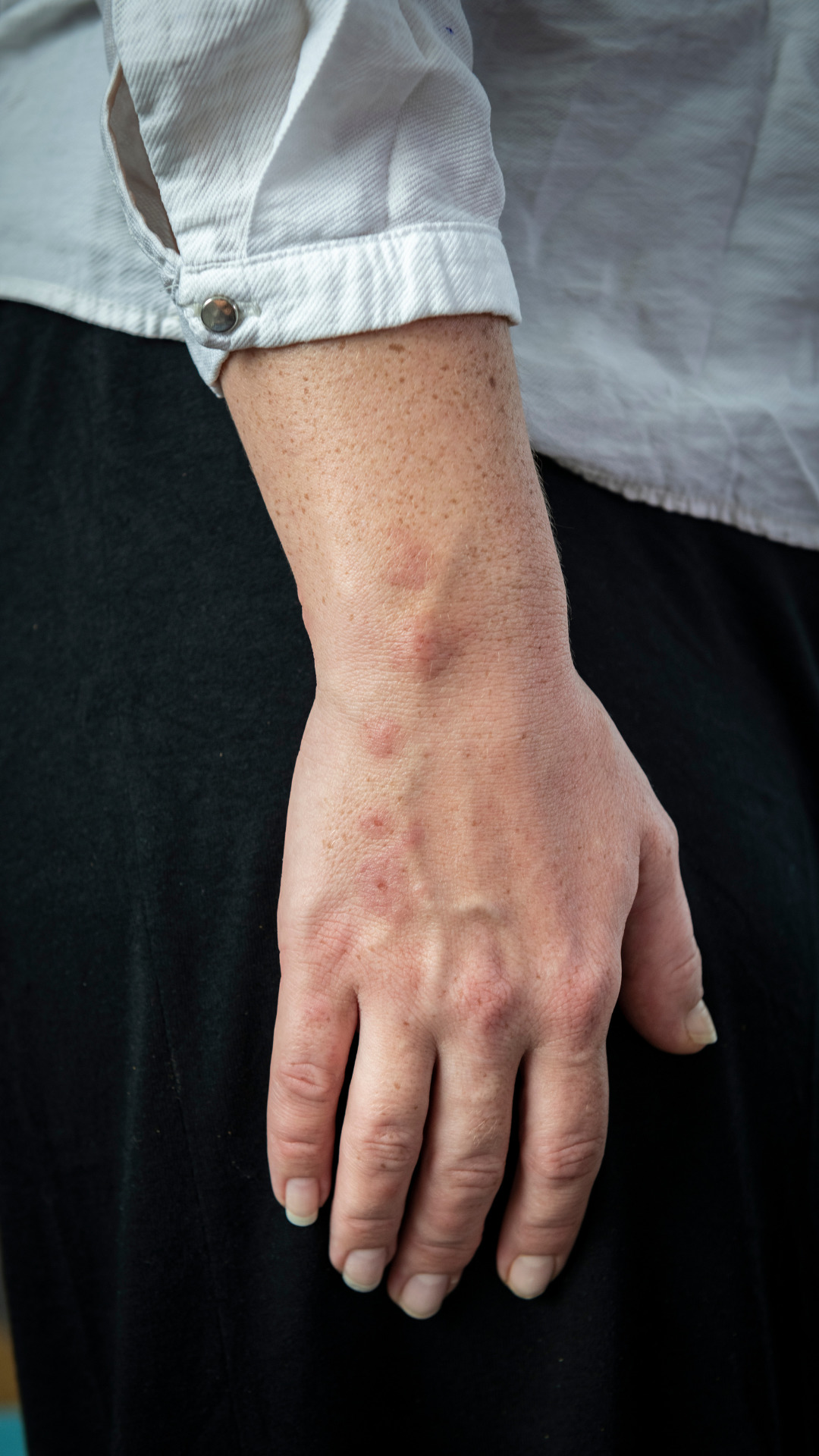 Detroit Rated One Of The Worst Cities In America For Bed Bugs