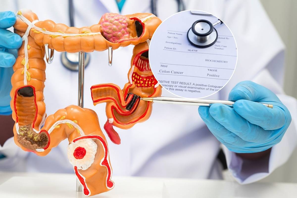 Free Colon Cancer Tests For Eligible Singaporeans In 2026